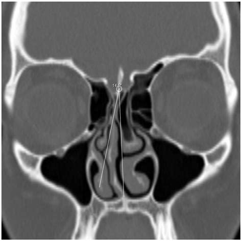 Maxillary Sinus Volume And Mucosal Thickening According To The Septal