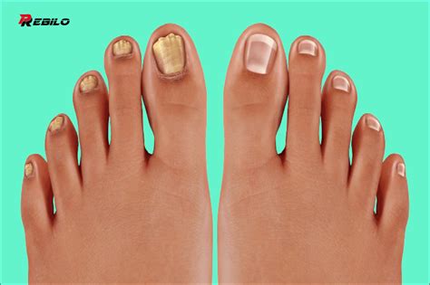 Get Rid Of Nail Fungus Forever — 2 Ingredient Recipe