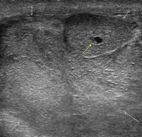 Elastographic Imaging Of Anaplastic Seminoma Of Testis With Its