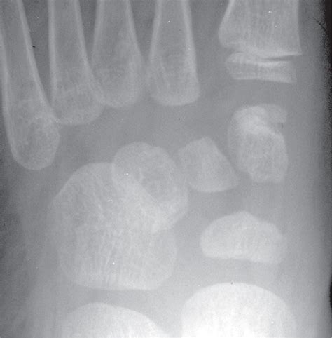 8 Developmental Variants Musculoskeletal Key