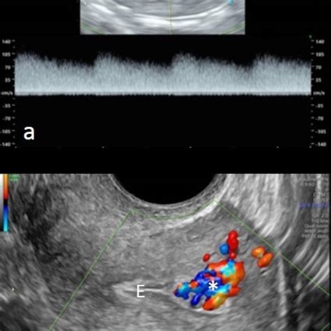 Transvaginal Ultrasound Of Patient 8 Sagittal Plane Of The Uterus A
