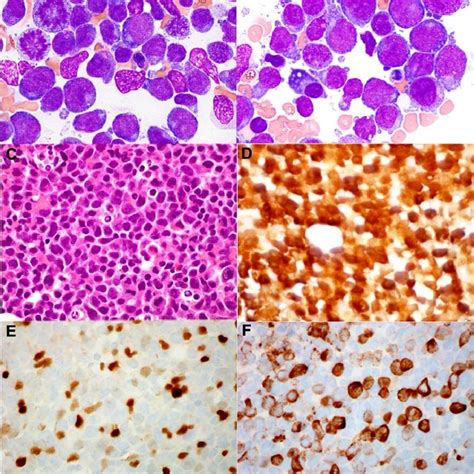 Bone Marrow Biopsy With B Myeloid Mixed Phenotype Acute Leukemia