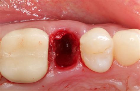 Extraction Socket Preservation Grafting Immediate Vs Delayed