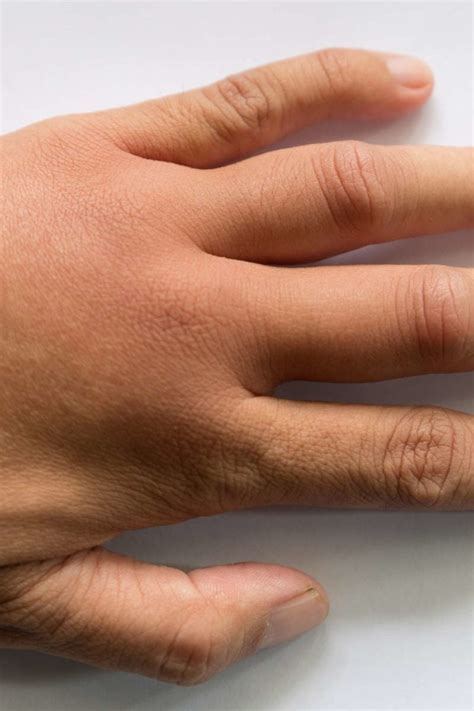 How To Cure Swollen Hands Werohmedia
