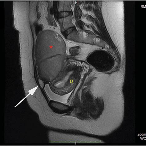 Pdf Unexpected Finding Of Urachal Remnant Cyst Tips For Laparoscopic