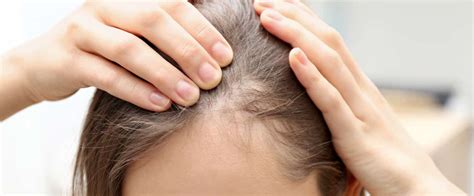 Causas Da Alopecia E Como Tratar Dra Angélica Pacheco