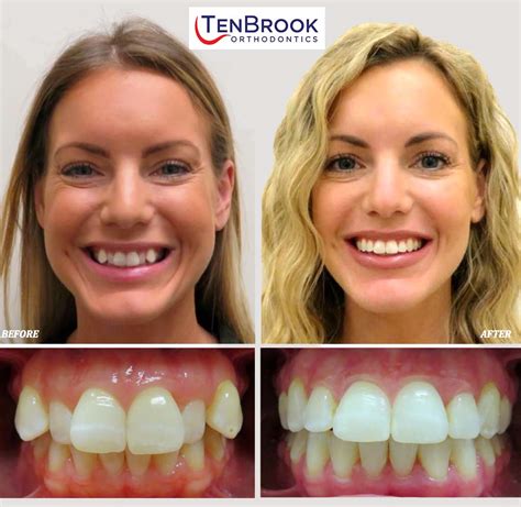 Braces Before And After Smile
