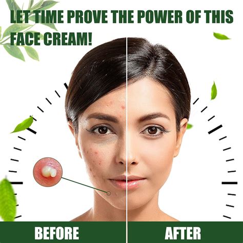 Acne Spot Treatment Hormonal Acne Treatment For Face，back And Body