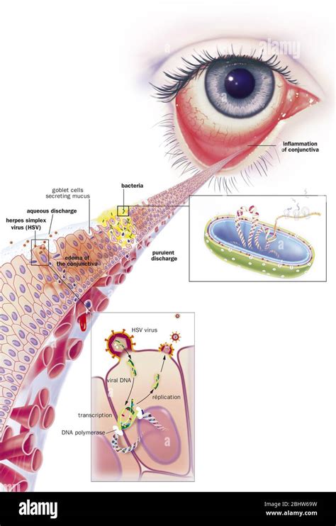 Conjuntivtis Infecciosa Y Sus Tratamientos Vista De Un Ojo Con