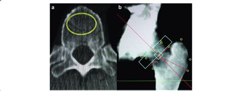 Qct Bmd Measurements Examples For Quantitative Computed Tomography