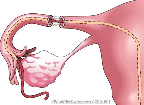 Information Leaflet Female Sterilization Reversals Female