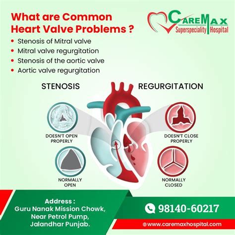 What Are Common Heart Valve Problems Stenosis Of Mitral Valve