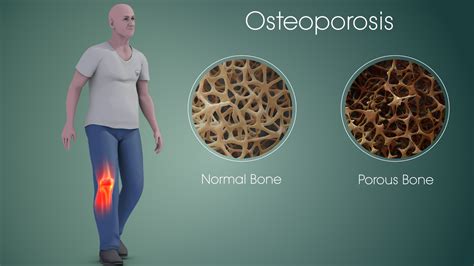 Male Osteoporosis It Deserves Attention Now Scientific Animations