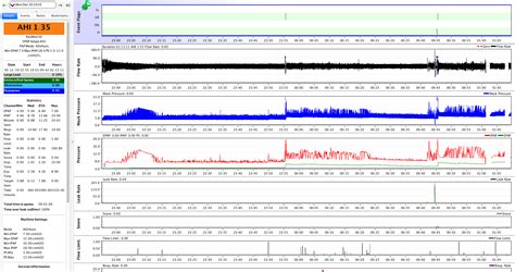 asv settings for treatment of complex sleep apnea apnea