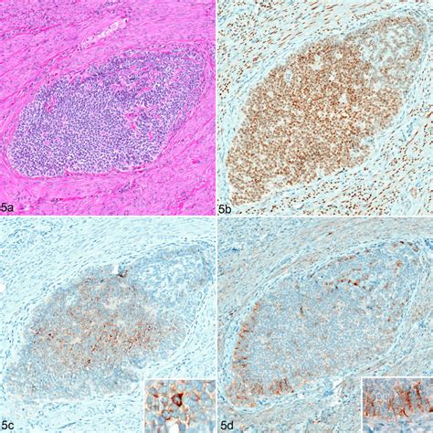 Uterine Tumor Resembling Ovarian Sex Cord Tumors Baboon Case 2 A