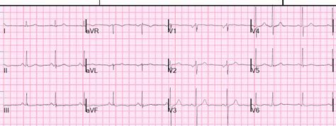 Dr Smiths Ecg Blog How Much St Depression In V2 And V3 Is Acceptable