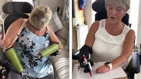 Sepsis Survivor With Amputated Limbs Spreads Awareness Youtube