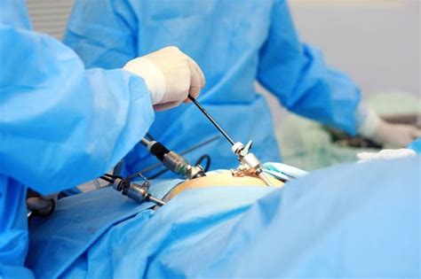 Laparoscopy And Infertility