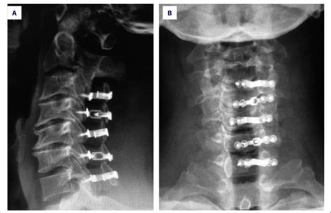 Postoperative Lateral A And Anteroposterior B Radiographs Of A