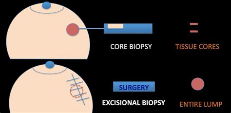 Breast Cancer Diagnosis The American Society Of