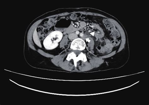 A Transverse View On Cect Scan Showed Left Common Iliac Lymph Node