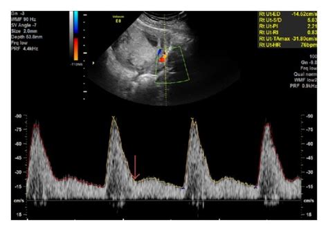 Transvaginal Doppler Interrogation Of The Uterine Artery At The