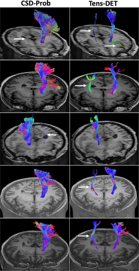 frontiers constrained spherical deconvolution tractography in the