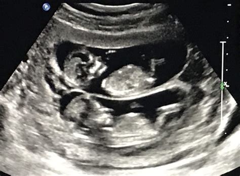12 Weeks Pregnant With Twins Tips Advice And How To Prep Twiniversity