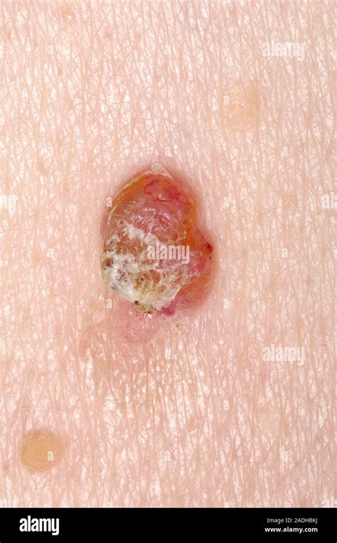Basal Cell Carcinoma Bcc Or Rodent Ulcer On A 68 Year Old Womans