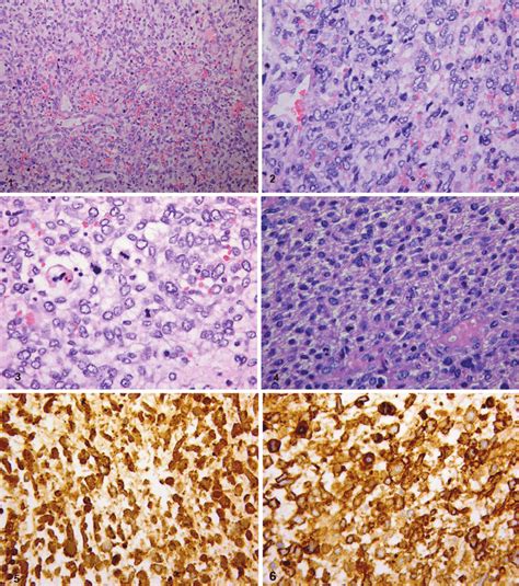 Pleomorphic Cells With Numerous Hyperchromatic Nuclei Download