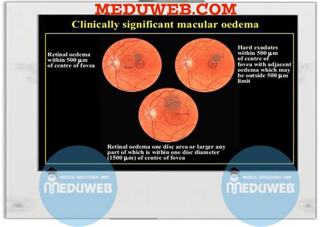 Diabetic Eye Disease Meduweb