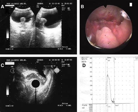A Preoperative Evaluation Of The Prostate By Transrectal Ultrasound