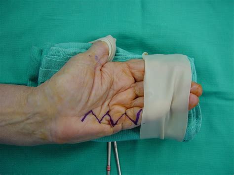 Dupuytrens Palmar Fasciectomy Central And Ulnar Double Cord