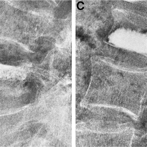 Four Types Of Bone Cement Distribution A Bone Cement Contacted Both