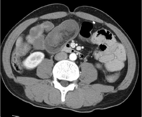 Figure 1 From Peutz Jeghers Syndrome With Intussusception Semantic