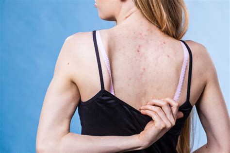 Littekens Acne Op De Rug Wat Te Doen Huid Met Zorg Hengelo