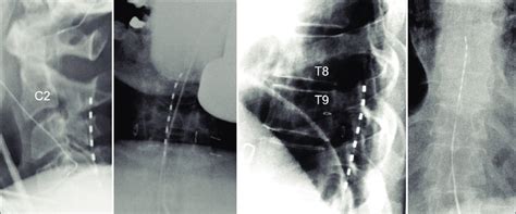 Postoperative Lateral A And Posterior Anterior B Radiographs Of
