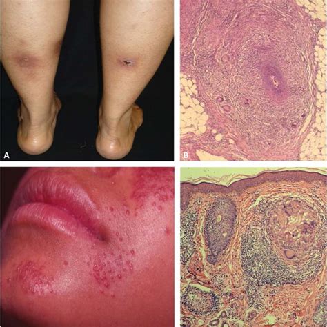 Clinical Data Of 30 Patients With Cutaneous Tuberculosis Download