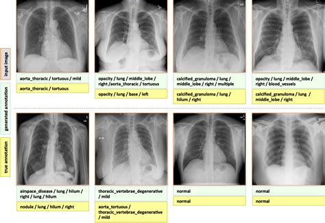 how deep learning can use chest x rays to detect disease