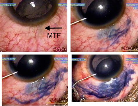 Minimally Invasive Glaucoma Surgery Strategies For Success Intechopen