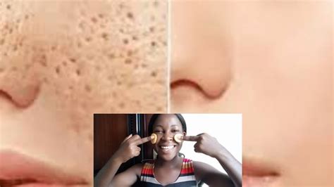 How To Get Rid Of Large Open Pores Permanently Minimize Large Pores