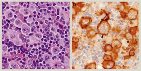 Hodgkin Lymphoma Medicine