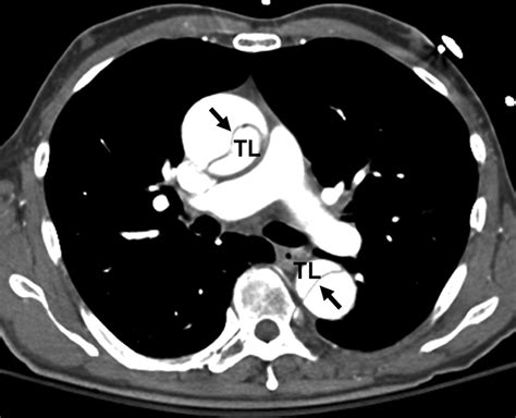 Aortic Dissection Rcemlearning