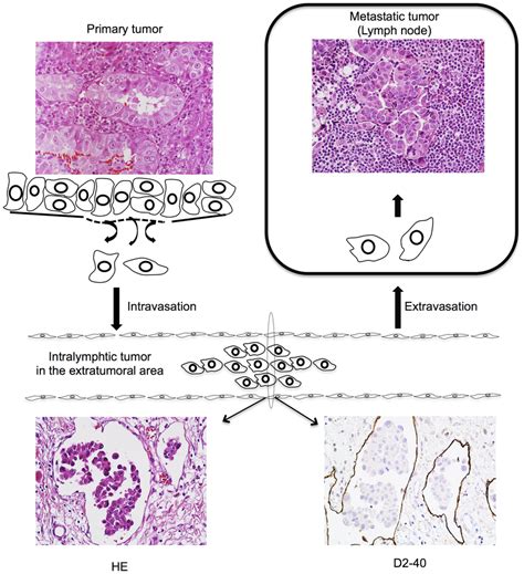 Scheme Showing The Process Of Lymphogenic Metastasis Download