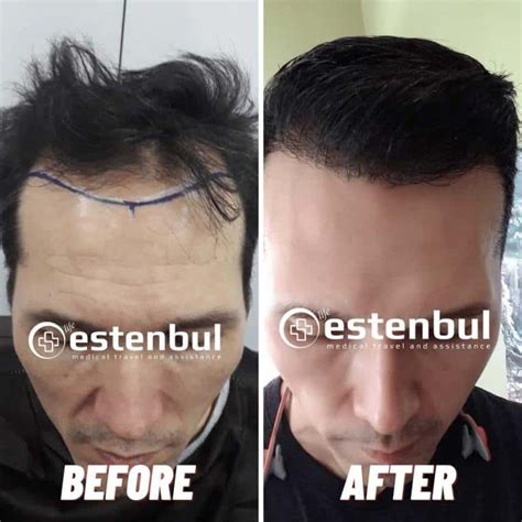 Hair Transplant Cost Turkey 2024 Estenbul Health