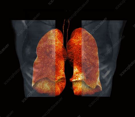 Emphysema Ct Scan Stock Image C048 8759 Science Photo Library