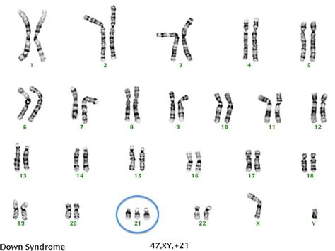 Down Syndrome Karyotype Trisomy 21 Embryology Down Syndrome May