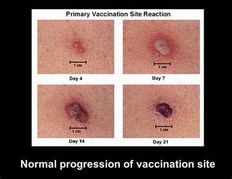 Bcg Vaccination Pakenham Medical Clinic