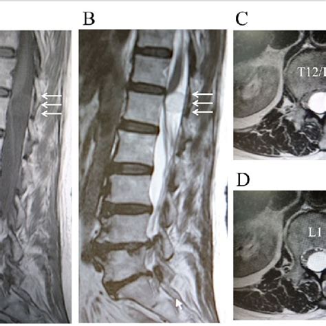 Magnetic Resonance Imaging Mri Of The Thoracolumbar Spine