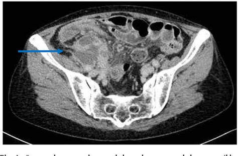 Interval Laparoscopic Appendectomy After Laparotomy Drainage For Acute